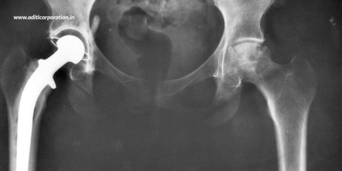 What Is A Revision Hip Replacement Surgery? - Aditi Corporation